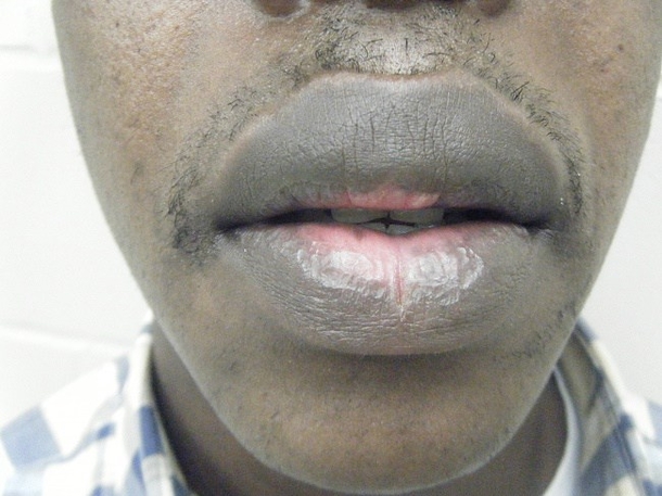 Cigarette Effects On Lips | Lipstutorial.org